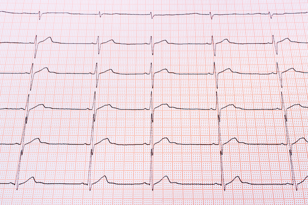 World Heart Rhythm Week - John T. Milliken Department of Medicine